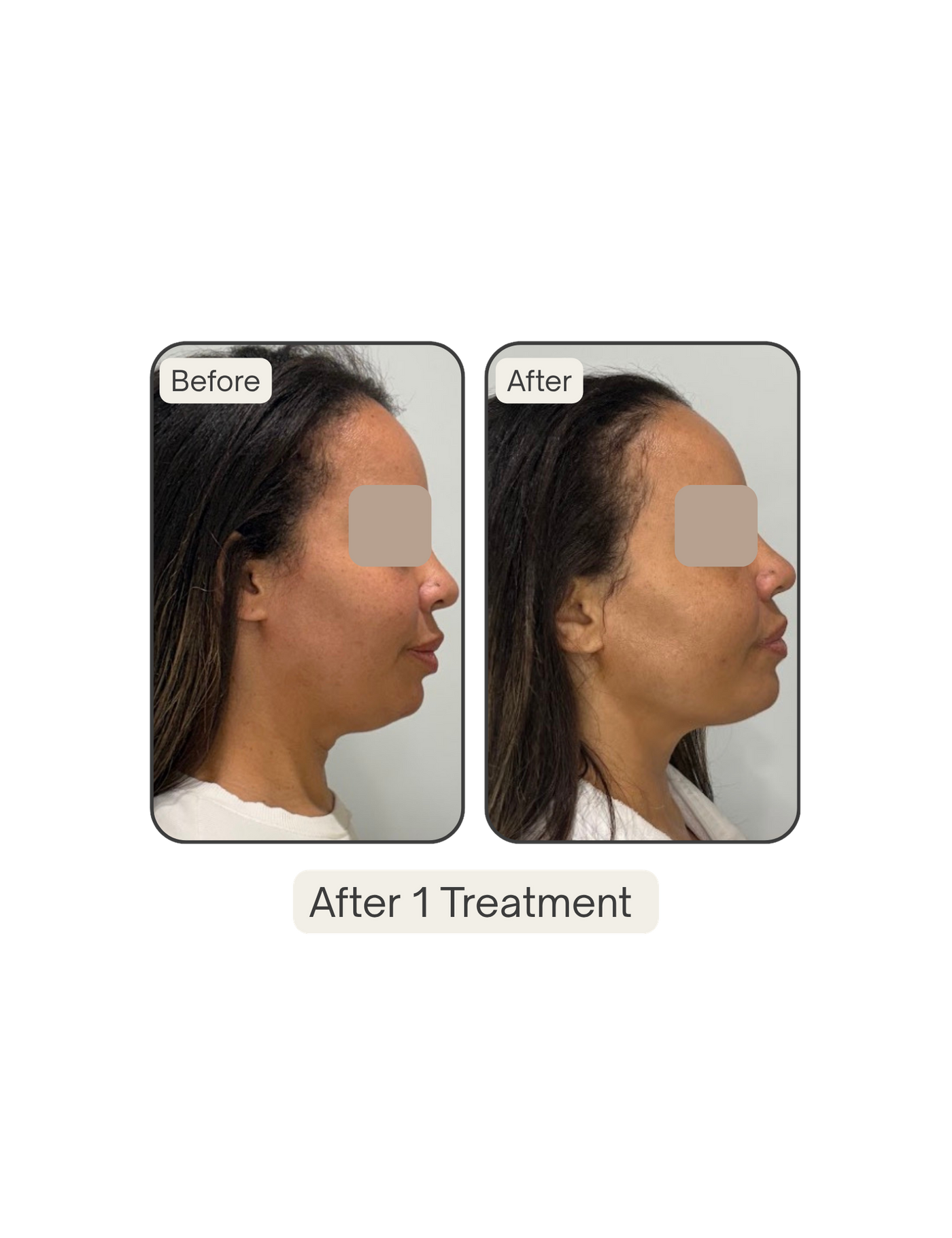 XERF Structural Skin Tightening in Los Angeles, CA – Curiva Med Spa