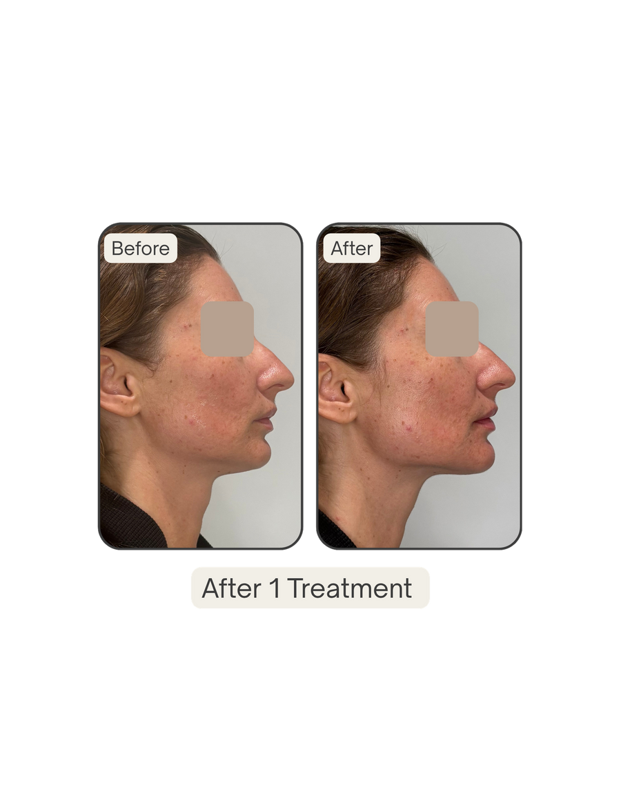 XERF Structural Skin Tightening in Los Angeles, CA – Curiva Med Spa